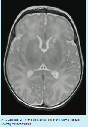 Coagulasenegative Staphylococcus Morphology Visualised