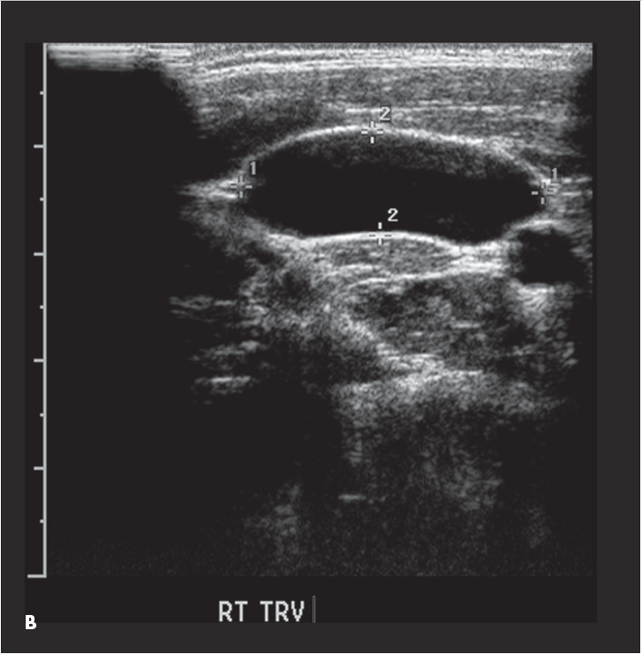 Internal Jugular Phlebectasia | Consultant360