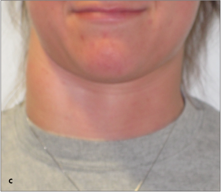 Internal Jugular Phlebectasia | Consultant360