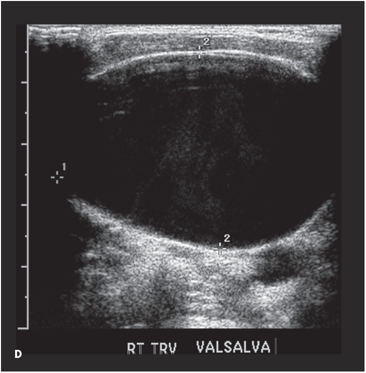 Internal Jugular Phlebectasia | Consultant360