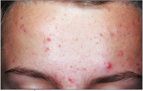 Is topical therapy the best choice for this teenaged boy’s acne ...