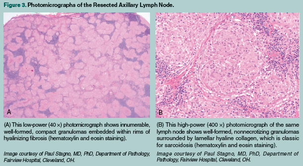Sarcoidosis Presenting as Symptomatic Hypercalcemia in an Octogenarian ...