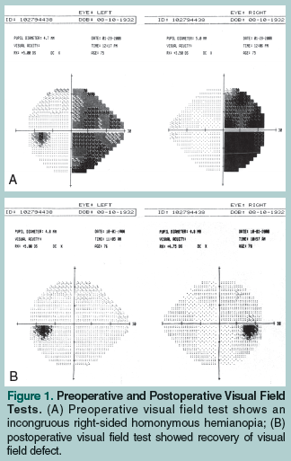 Reversible, Chronic Homonymous Hemianopia Due to a Suprasellar ...