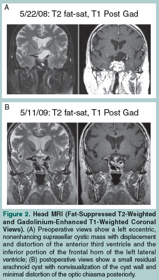 Reversible, Chronic Homonymous Hemianopia Due to a Suprasellar ...