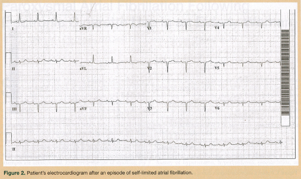 68yearold Woman With Paroxysmal Atrial Fibrillation Heart
