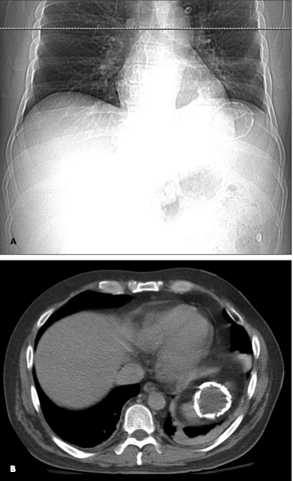 Calcified Splenic Cyst | Consultant360