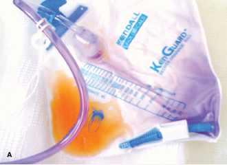 Purple Urine Bag Syndrome | Consultant360
