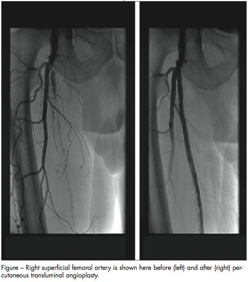 Peripheral Arterial Disease: Diagnosis and Treatment | Consultant360