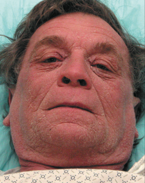 A 56-year-old man with diffuse erythema | Consultant360