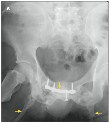 Myositis Ossificans | Consultant360