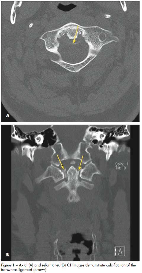Severe Neck Pain Due to Crowned Dens Syndrome | Consultant360