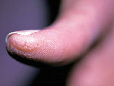 Is this stubborn lesion a “callus” - or something else? | Consultant360