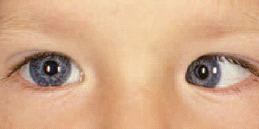 Strabismus: What to Tell Parents and When to Consider Surgery ...