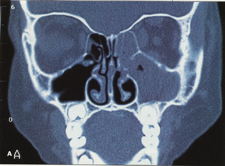 What do you suspect is responsible for the marked redness and swelling ...