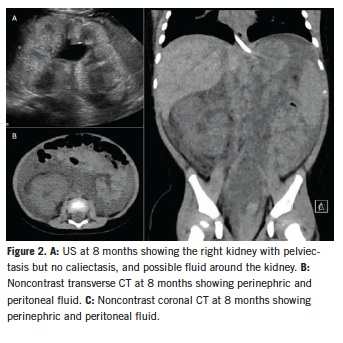 Renal Cystic Dysplasia | Consultant360