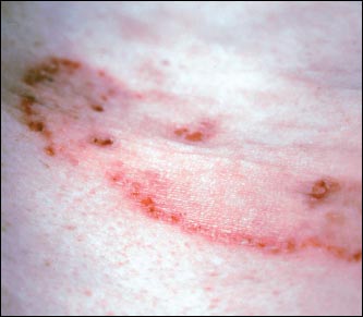How do you explain this persistent pruritic rash? | Consultant360