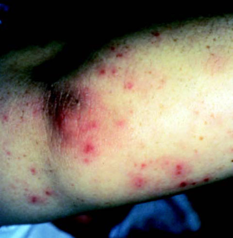 Infectious Disease Emergencies: Part 1, Fever and Rash | Consultant360