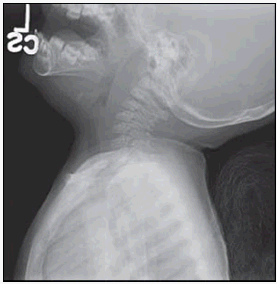 Child With Fever and Neck Pain | Consultant360