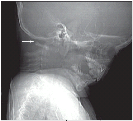 Torticollis and Fever: A Case of Grisel Syndrome From Group A ...
