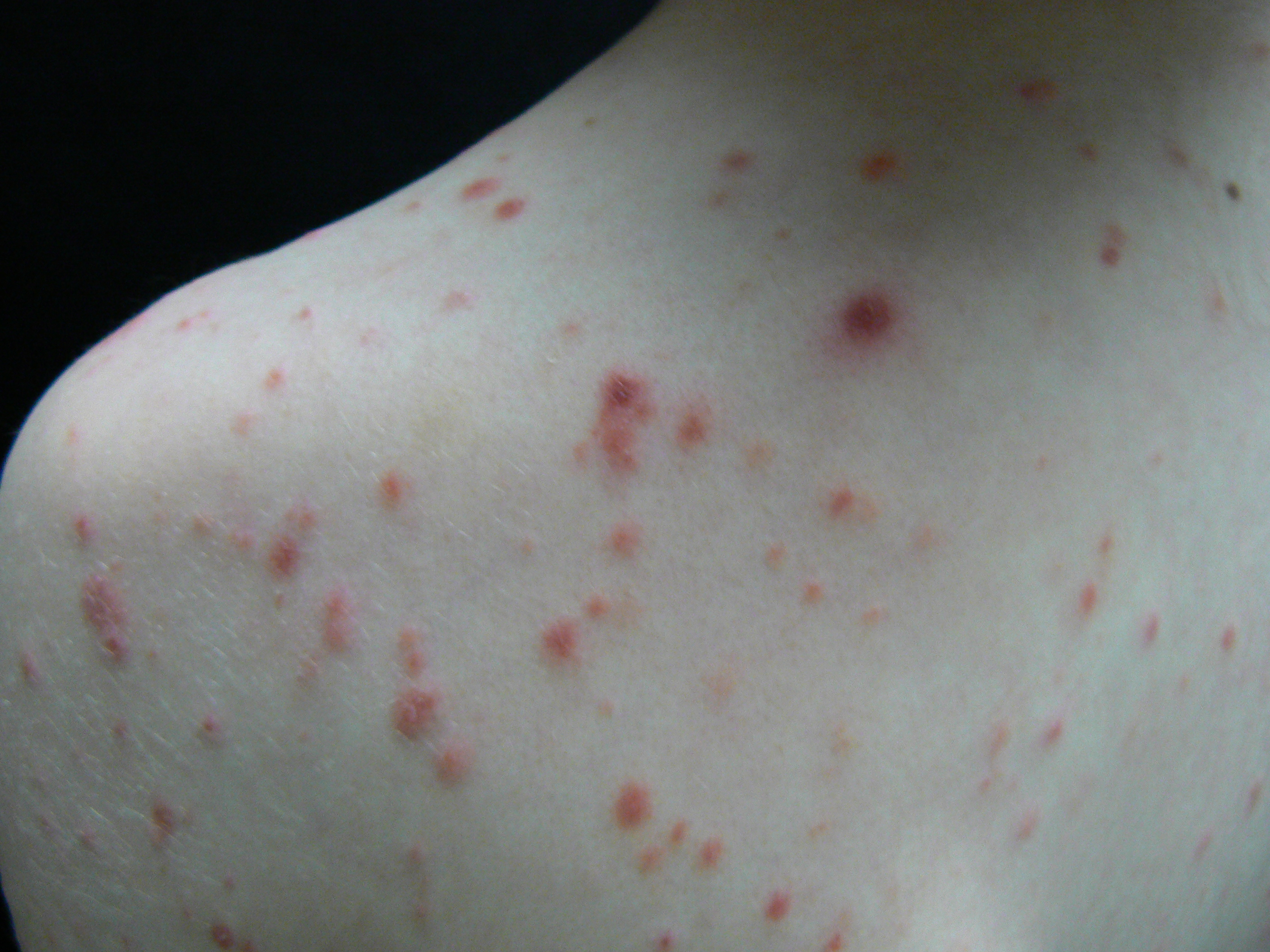 Diffuse Red Eruptions in a Young Boy | Consultant360