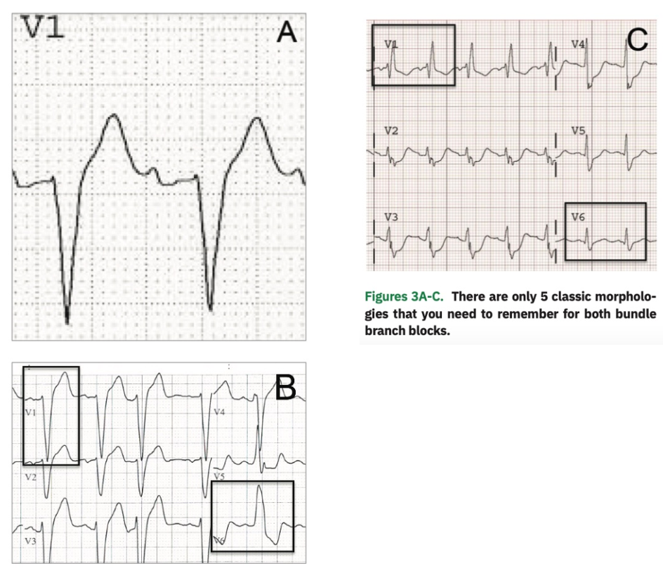 Wide Complex Tachycardias: Making the Brugada Criteria More User Friendly