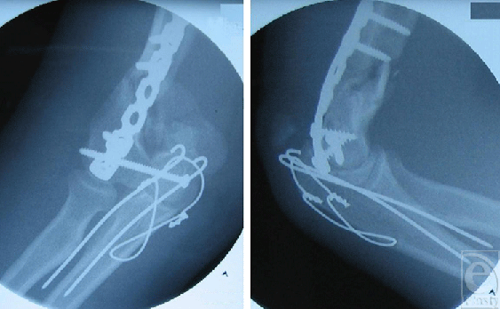 Reconstruction of a Severe Open Distal Humerus Fracture With Complete ...