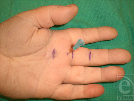 Assessment of the Distal Extent of the A1 Pulley Release: A New Technique