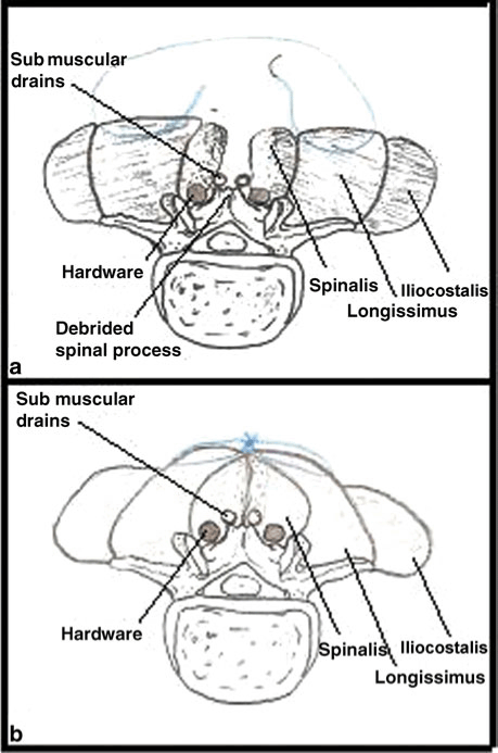 Technical Changes in Paraspinous Muscle Flap Surgery Have Increased ...