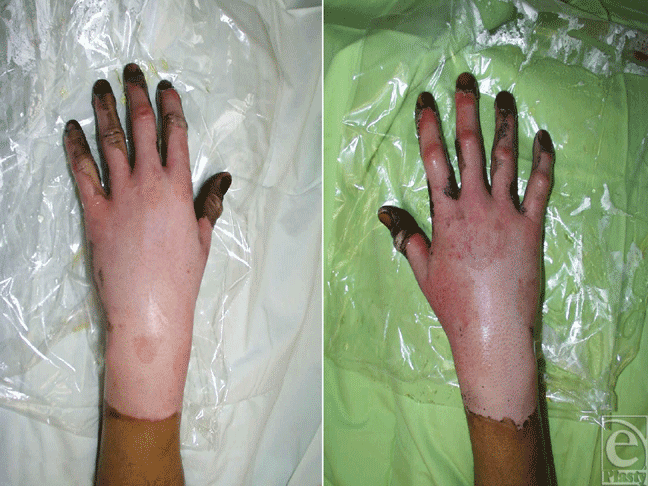 Burn Injury and Explosions: An Australian Perspective