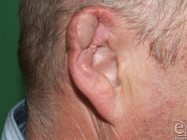 One-Stage Ear Reconstruction After Avulsion Injury, Using the Amputated ...
