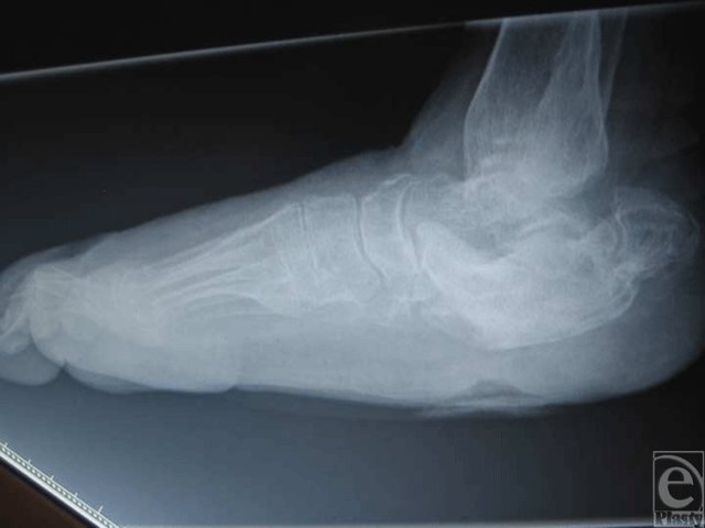 Partial Calcanectomy in High-Risk Patients With Diabetes: Use and ...