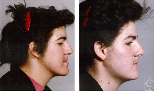 Changes in the Gonial Angle Following Bilateral Sagittal Split ...