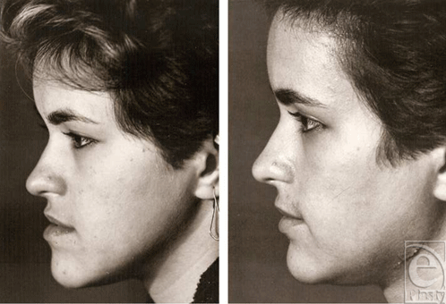 Changes in the Gonial Angle Following Bilateral Sagittal Split ...