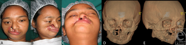 CASE REPORT Journey of a Noma Face