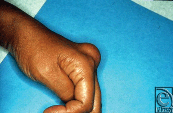 Lipomas of the Hand: A Review and 13 Patient Case Series