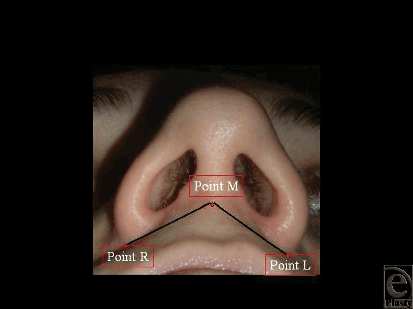 An Alternative Alar Cinch Suture