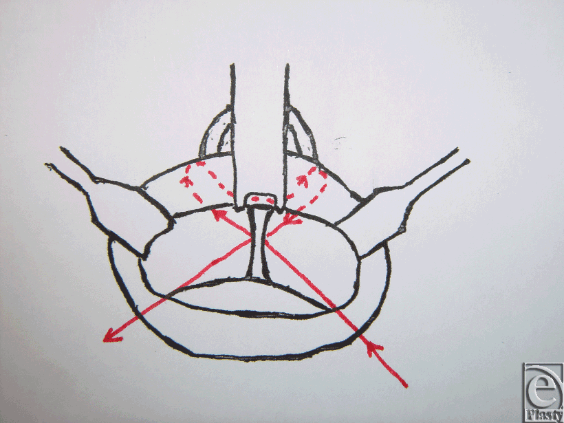 An Alternative Alar Cinch Suture
