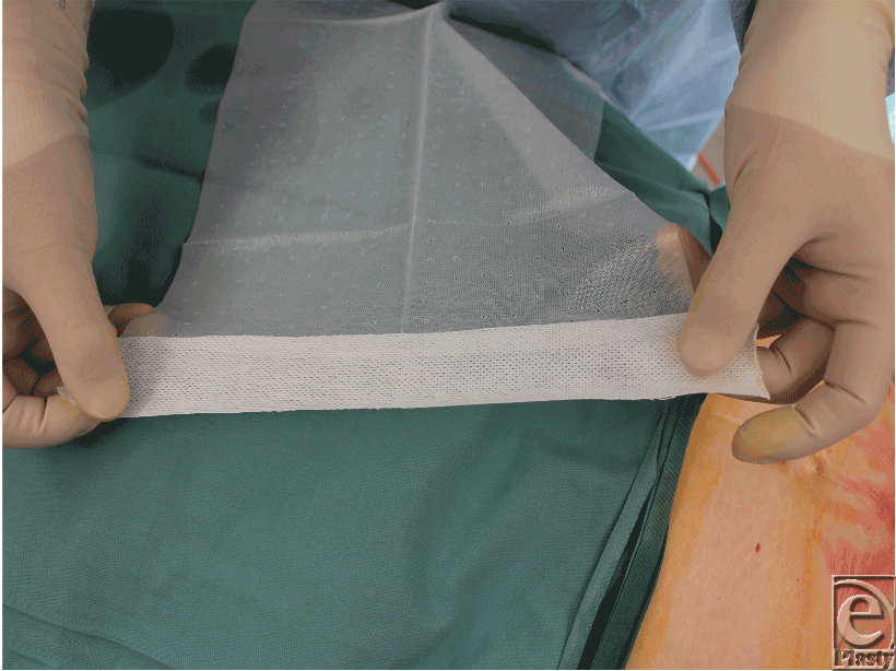 Using Biobrane: Techniques to Make Life Easier