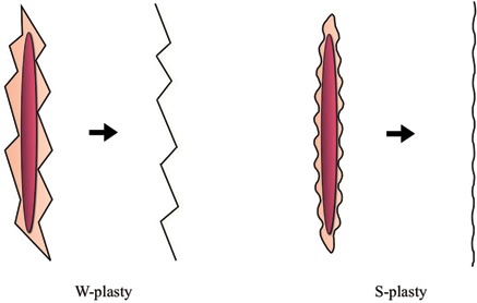 LETTER TO THE EDITOR S-Plasty Method for Secondary Scar Revision After ...