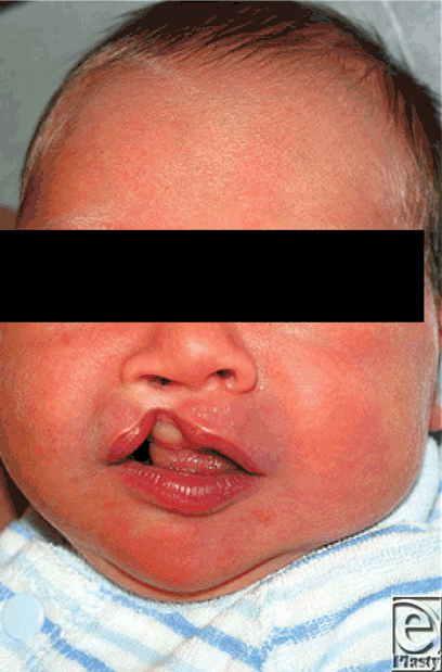 Cleft Lip and Palate