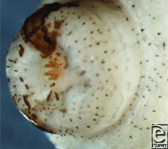 Cuterebral Ophthalmomyiasis Externa Presenting as Preseptal Cellulitis