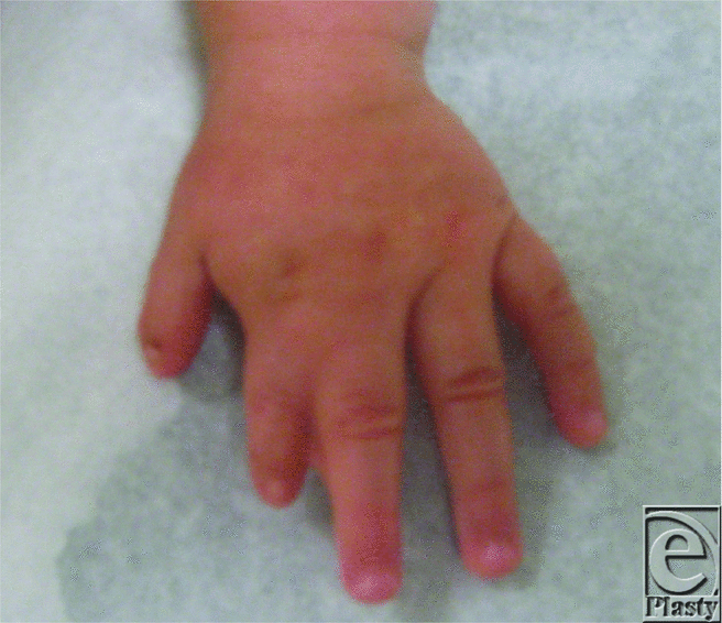 Mobius Syndrome and Poland Syndrome Presenting Together in a Single Patient