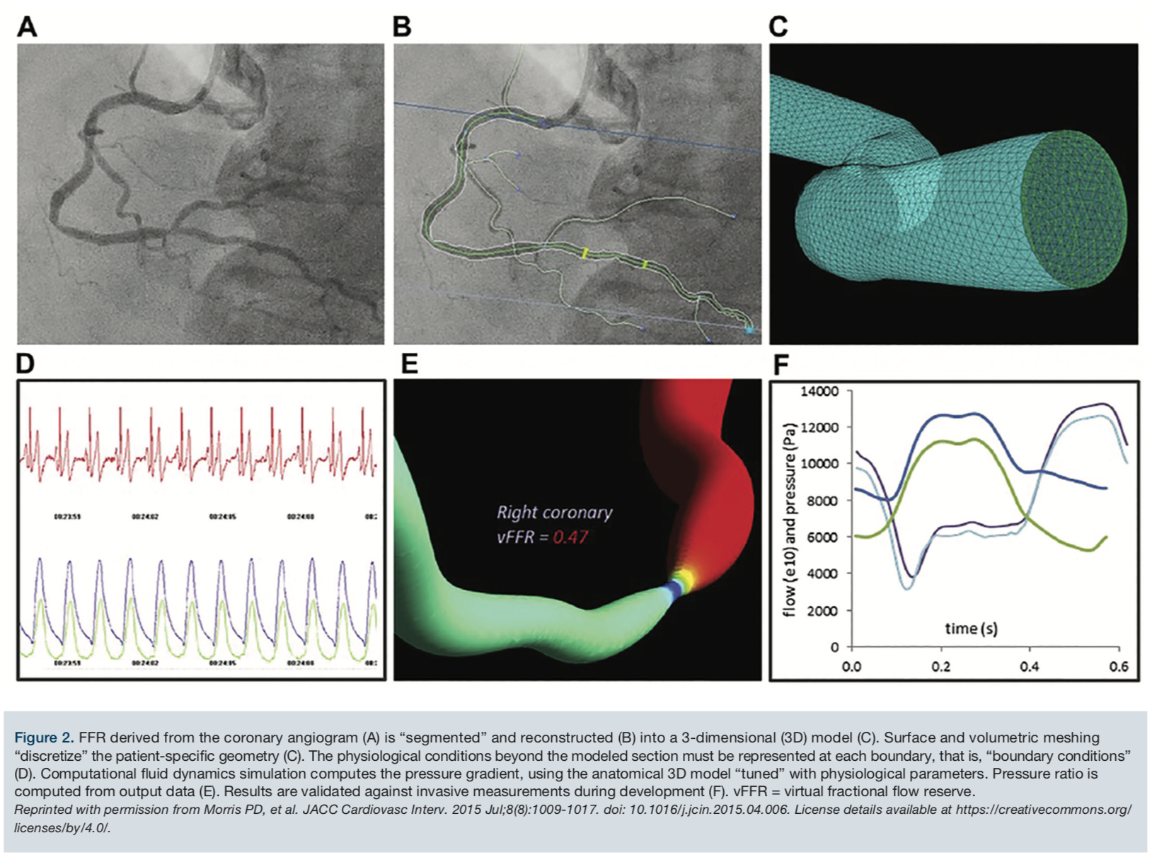 Noninvasive Angiographic-Derived FFR: Is Wireless Physiology Coming to ...