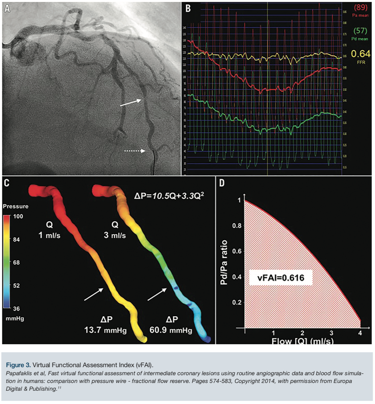 Noninvasive Angiographic-Derived FFR: Is Wireless Physiology Coming to ...