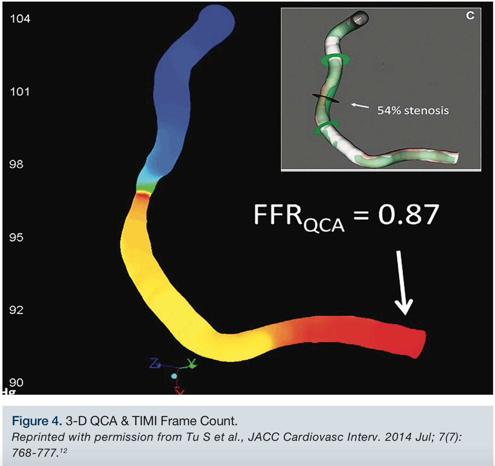 Noninvasive Angiographic-Derived FFR: Is Wireless Physiology Coming to ...