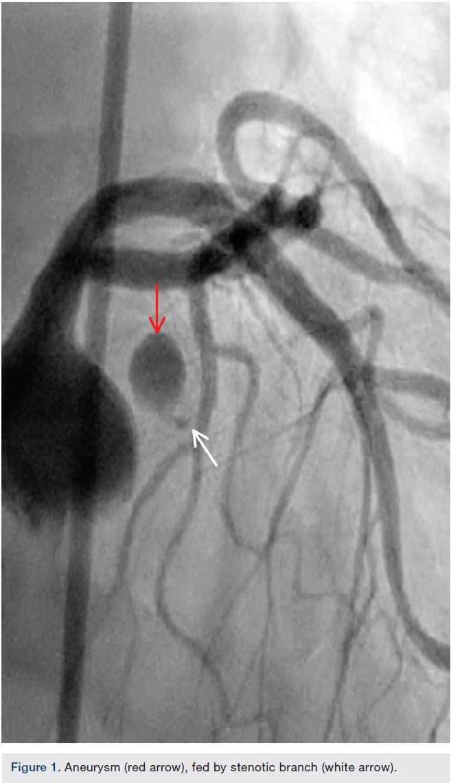 Coil Embolization of Large Coronary Artery Aneurysm Using Medtronic ...