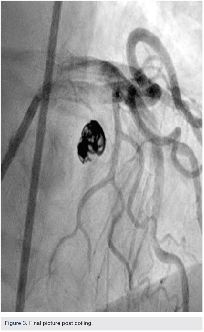 Coil Embolization of Large Coronary Artery Aneurysm Using Medtronic ...