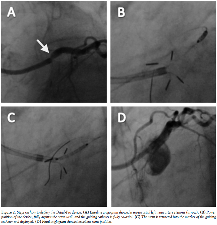 Perfection of Precise Ostial Stent Placement