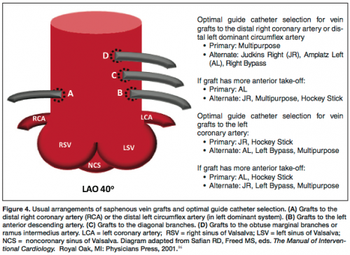 Saphenous Vein Graft Intervention: A Review