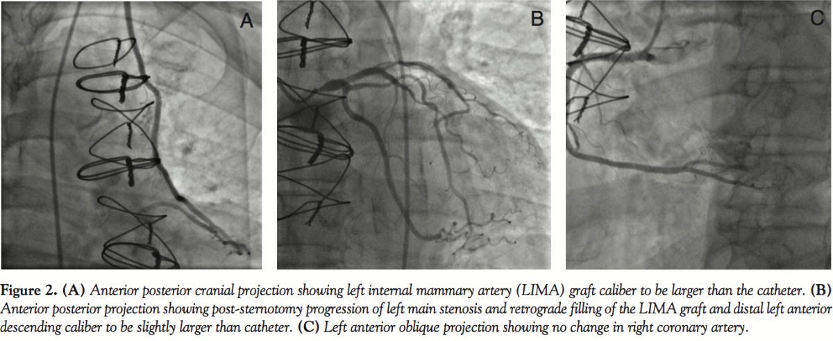 Atresia of the Left Internal Mammary Artery Graft Following ...